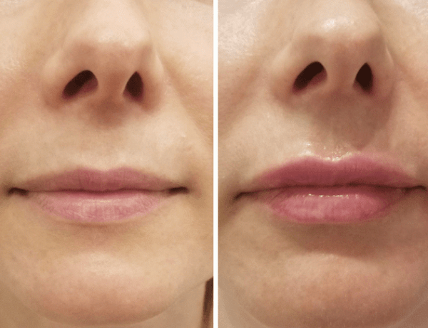 The Botox Lip Flip: Achieve a Fuller-Looking Pout - Orange County