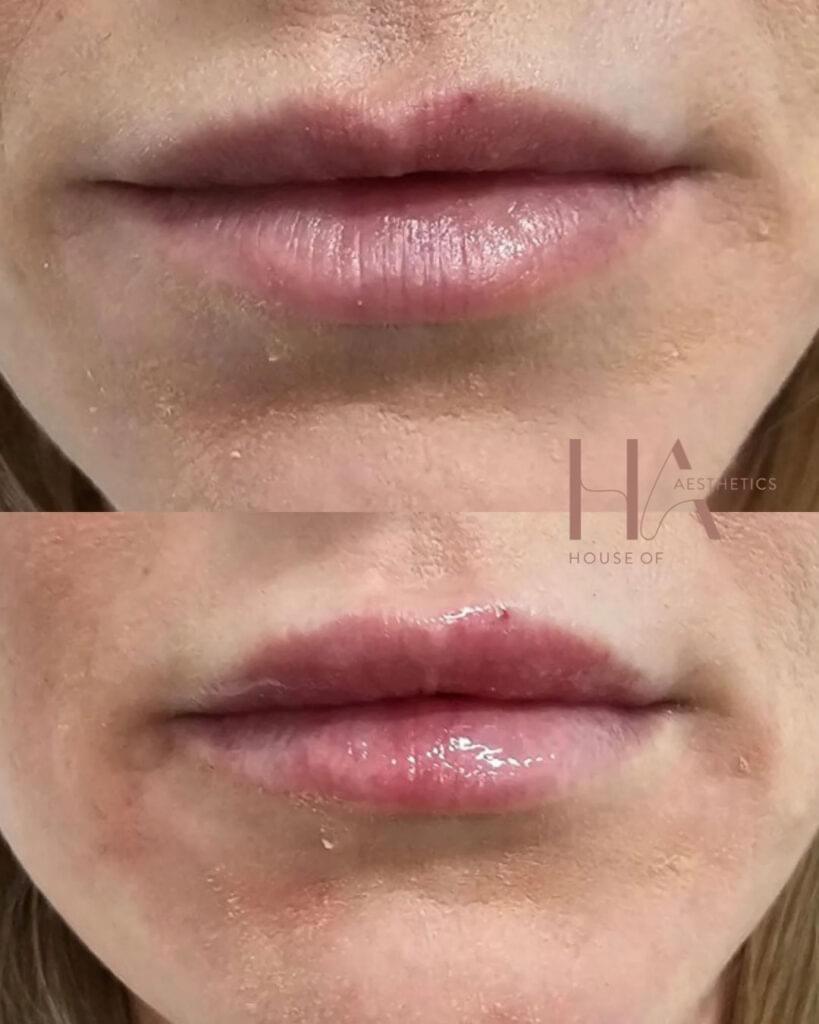 Lip Fillers Near You in Huntington Beach - Natural-looking Lips