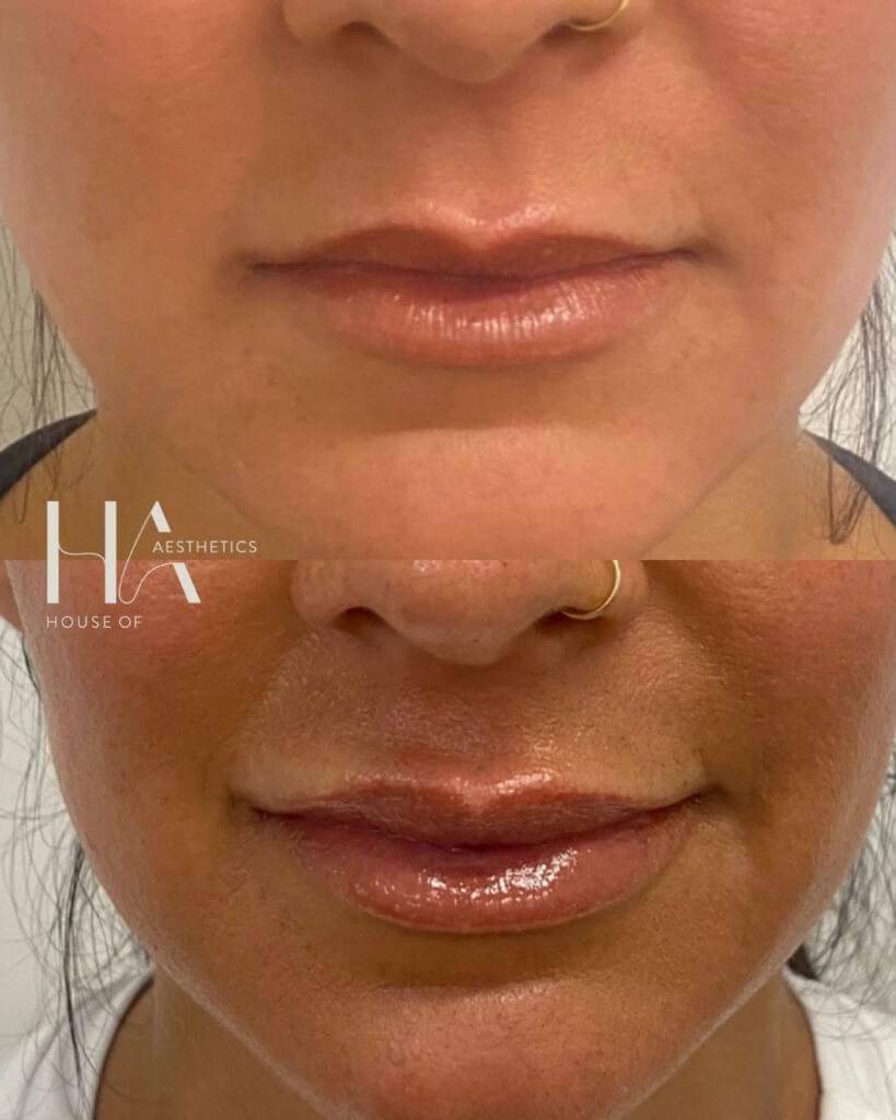 Lip Fillers Near You in Huntington Beach - Natural-looking Lips